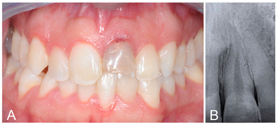 Anterior Esthetic Restorations with the Stratified Stamp Technique: A ...