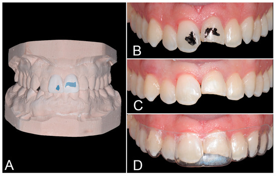 Anterior Esthetic Restorations with the Stratified Stamp Technique: A ...