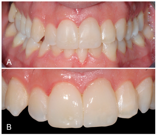 Anterior Esthetic Restorations with the Stratified Stamp Technique: A ...