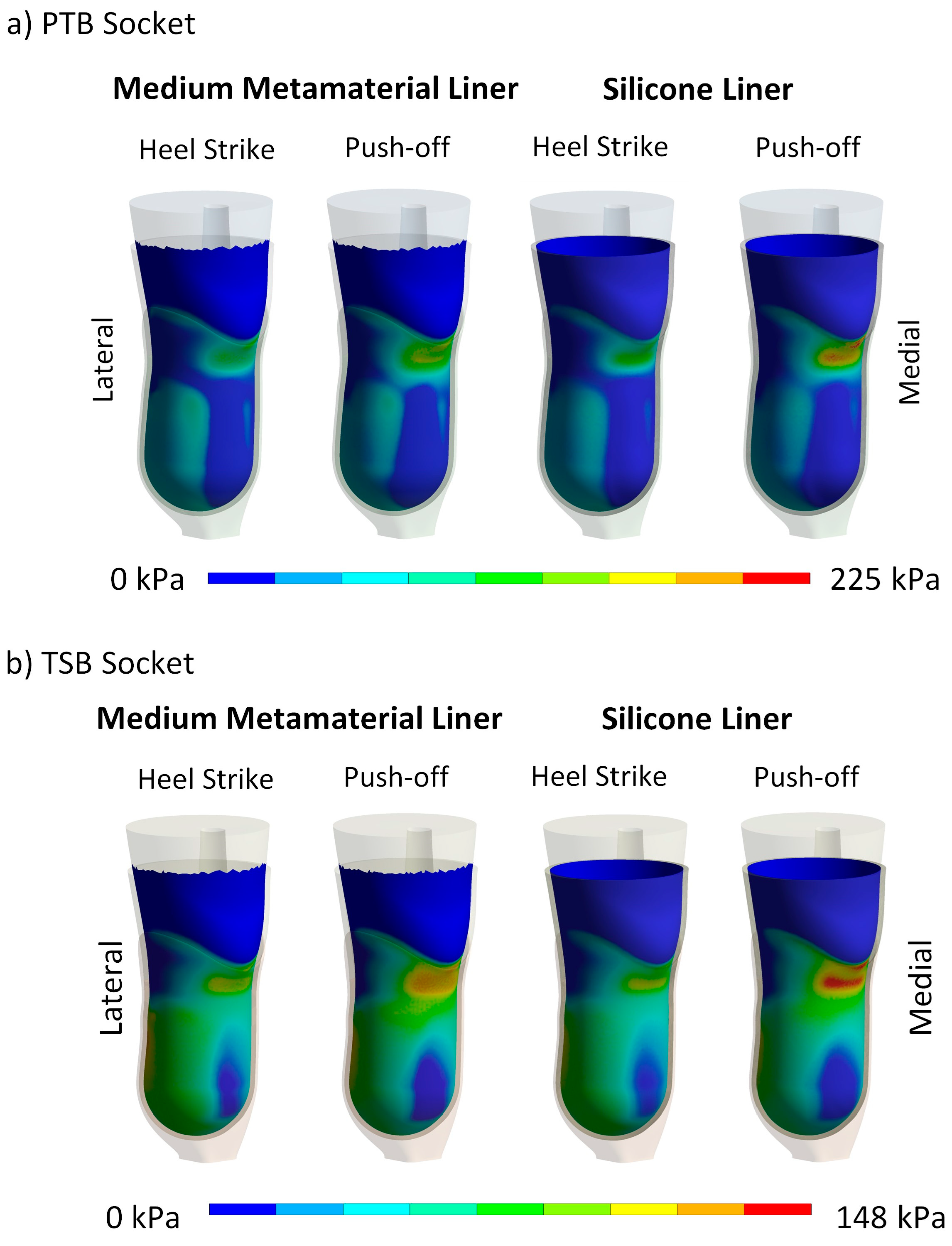 Bioinspired Design of 3D-Printed Cellular Metamaterial Prosthetic ...