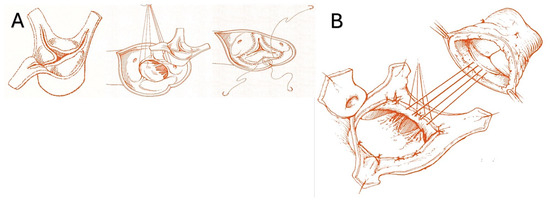 External Scaffold for Strengthening the Pulmonary Autograft in the Ross ...