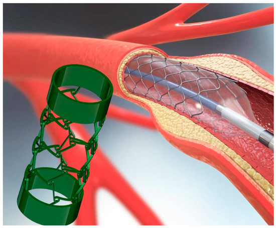 From Stents to Smart Implants Employing Biomimetic Materials: The ...