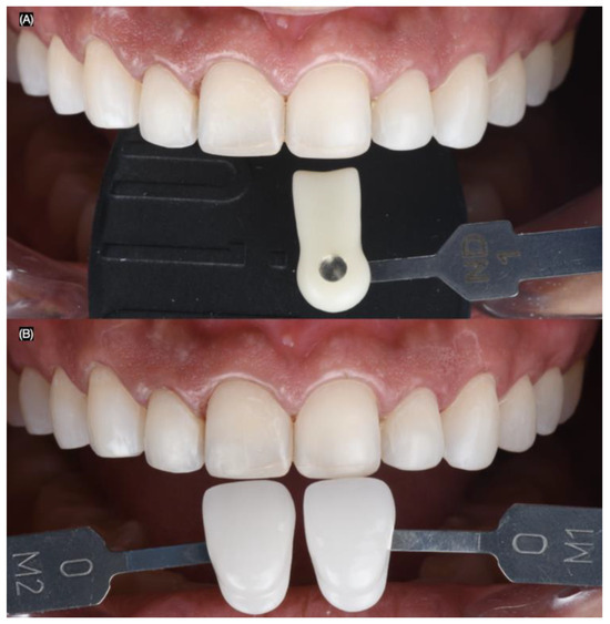 Bonding Protocols for Lithium Disilicate Veneers: A Narrative Review ...