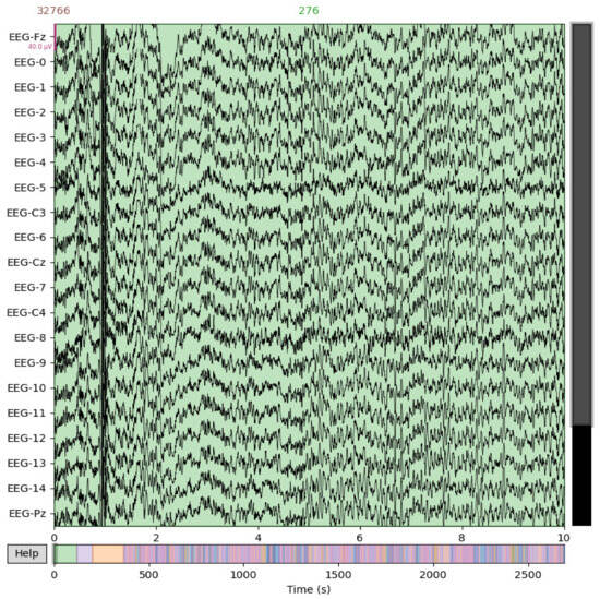 A Capsule Decision Neural Network Based on Transfer Learning for EEG Signal Classification