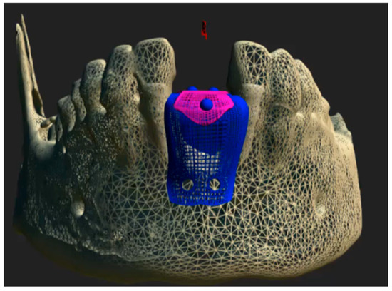 Guided Bone Regeneration Using a Modified Occlusive Barrier with a ...