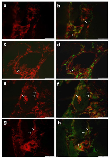 Myo-Inositol Transporter SLC5A3 Associates with Degenerative Changes ...