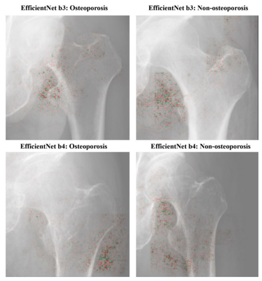 Deep Learning for Osteoporosis Classification Using Hip Radiographs and ...