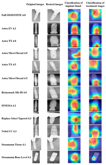 Multi-Task Deep Learning Model for Classification of Dental Implant Brand and Treatment Stage ...