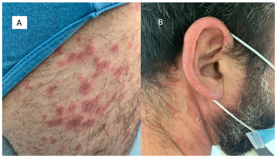 SARS-CoV-2 and Skin: The Pathologist’s Point of View