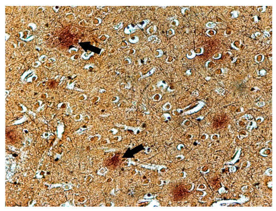 Neuropathological Changes in the Brains of Suicide Killers