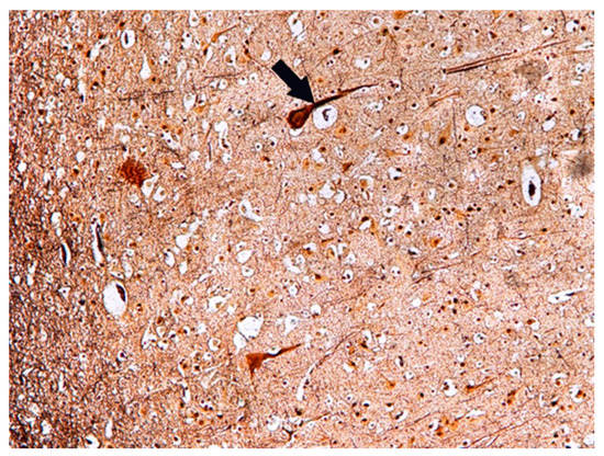 Neuropathological Changes in the Brains of Suicide Killers