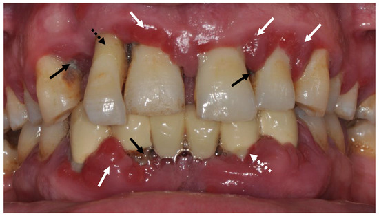 Targeting Nrf2 with Probiotics and Postbiotics in the Treatment of ...