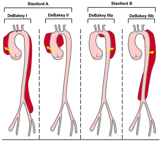 Emerging Role of Non-Coding RNAs in Aortic Dissection