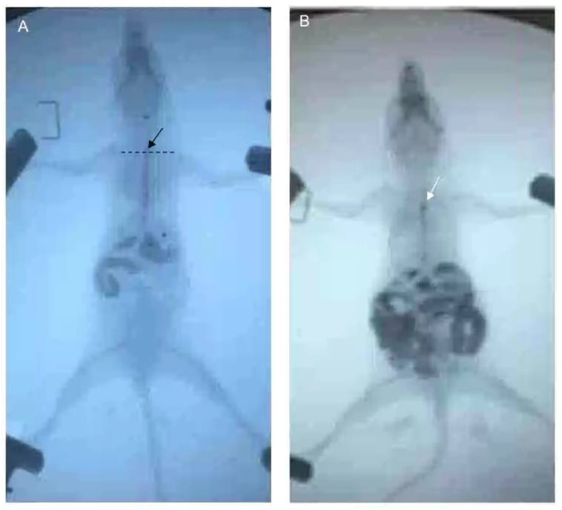 Eosinophils Infiltration in Esophageal Muscularis Propria Induces ...