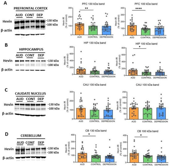 The Matricellular Protein Hevin Is Involved in Alcohol Use Disorder