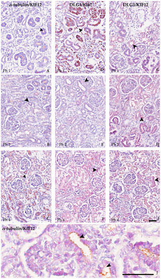 Spatio-Temporal Expression Pattern of CAKUT Candidate Genes DLG1 and ...