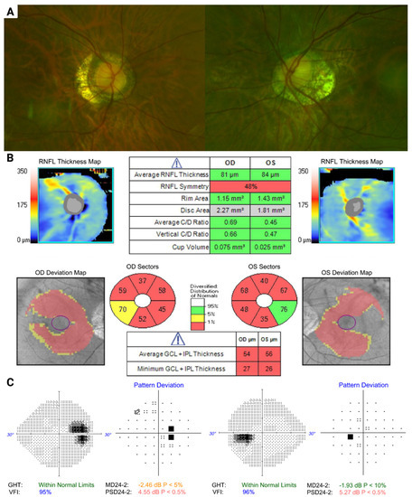 Glaucoma and Myopia: Diagnostic Challenges