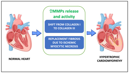 Metalloproteinases and Hypertrophic Cardiomyopathy: A Systematic Review