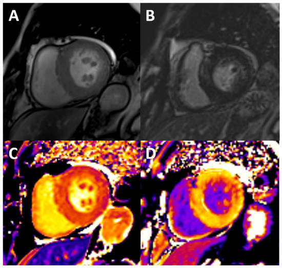Cardiac Imaging Biomarkers in Chronic Kidney Disease