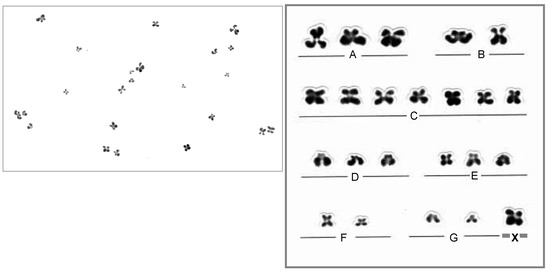Sperm and Oocyte Chromosomal Abnormalities