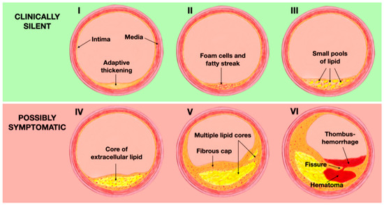 Novel Imaging-Based Biomarkers for Identifying Carotid Plaque Vulnerability
