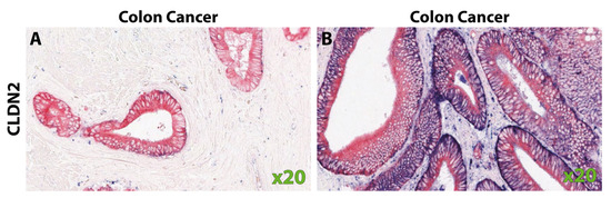 The Expression of the Claudin Family of Proteins in Colorectal Cancer