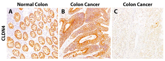 The Expression of the Claudin Family of Proteins in Colorectal Cancer