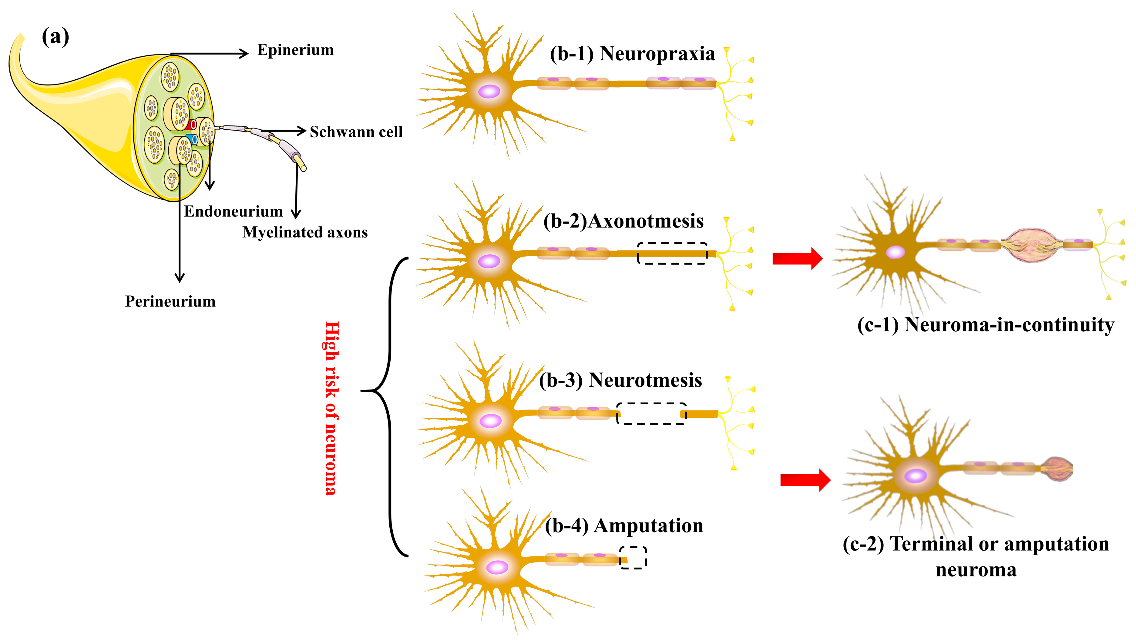 Strategies for Treating Traumatic Neuromas with Tissue-Engineered Materials