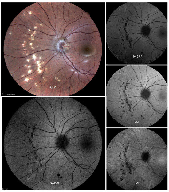 Fundus Autofluorescence in Posterior and Panuveitis—An Under-Estimated ...