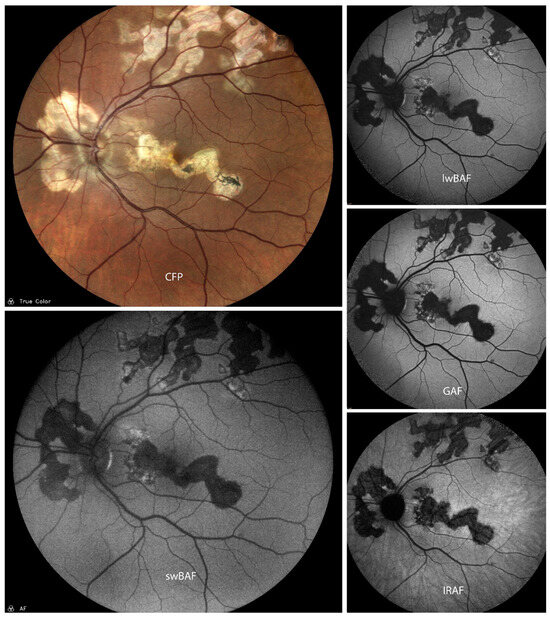 Fundus Autofluorescence in Posterior and Panuveitis—An Under-Estimated ...