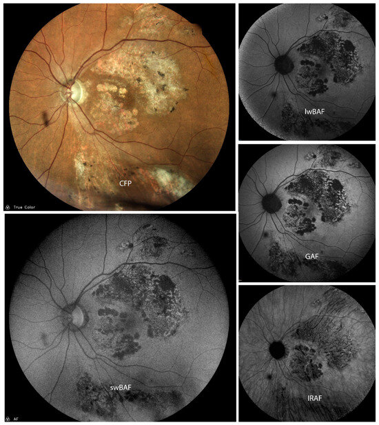 Fundus Autofluorescence in Posterior and Panuveitis—An Under-Estimated ...