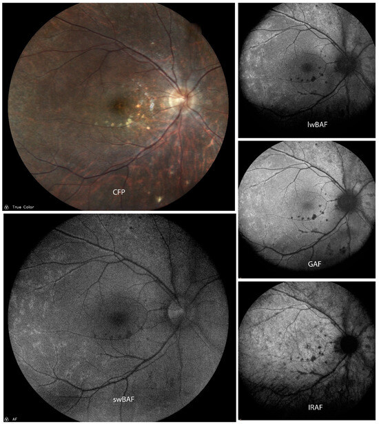 Fundus Autofluorescence in Posterior and Panuveitis—An Under-Estimated ...