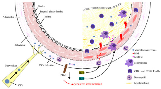 Exploring the Link between Varicella-Zoster Virus, Autoimmune Diseases ...