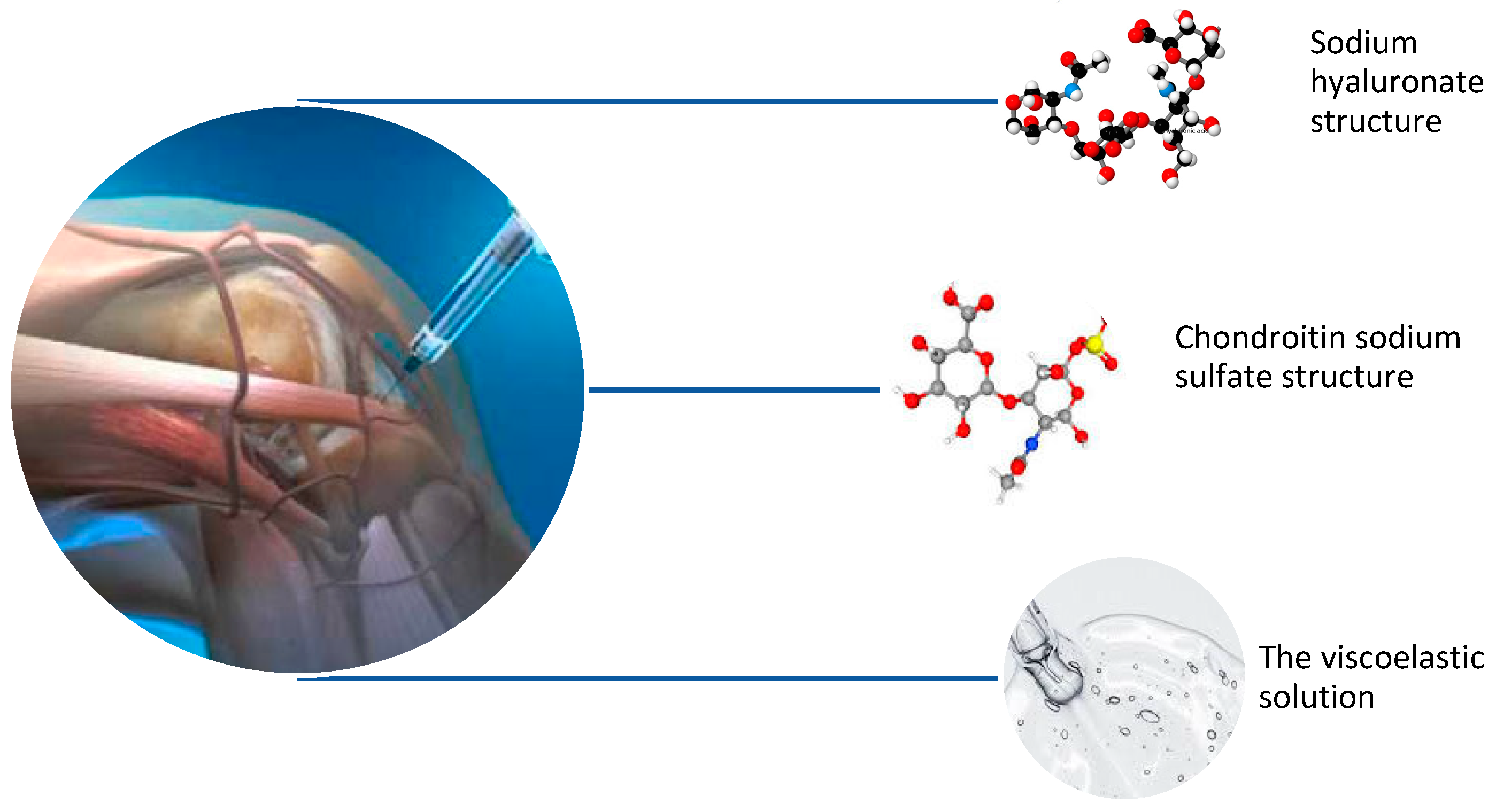 Can Hyaluronic Acid Combined with Chondroitin Sulfate in ...