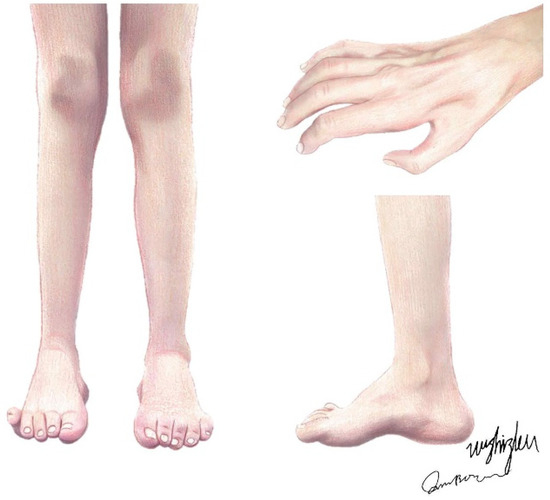 Current Treatment Methods for Charcot–Marie–Tooth Diseases