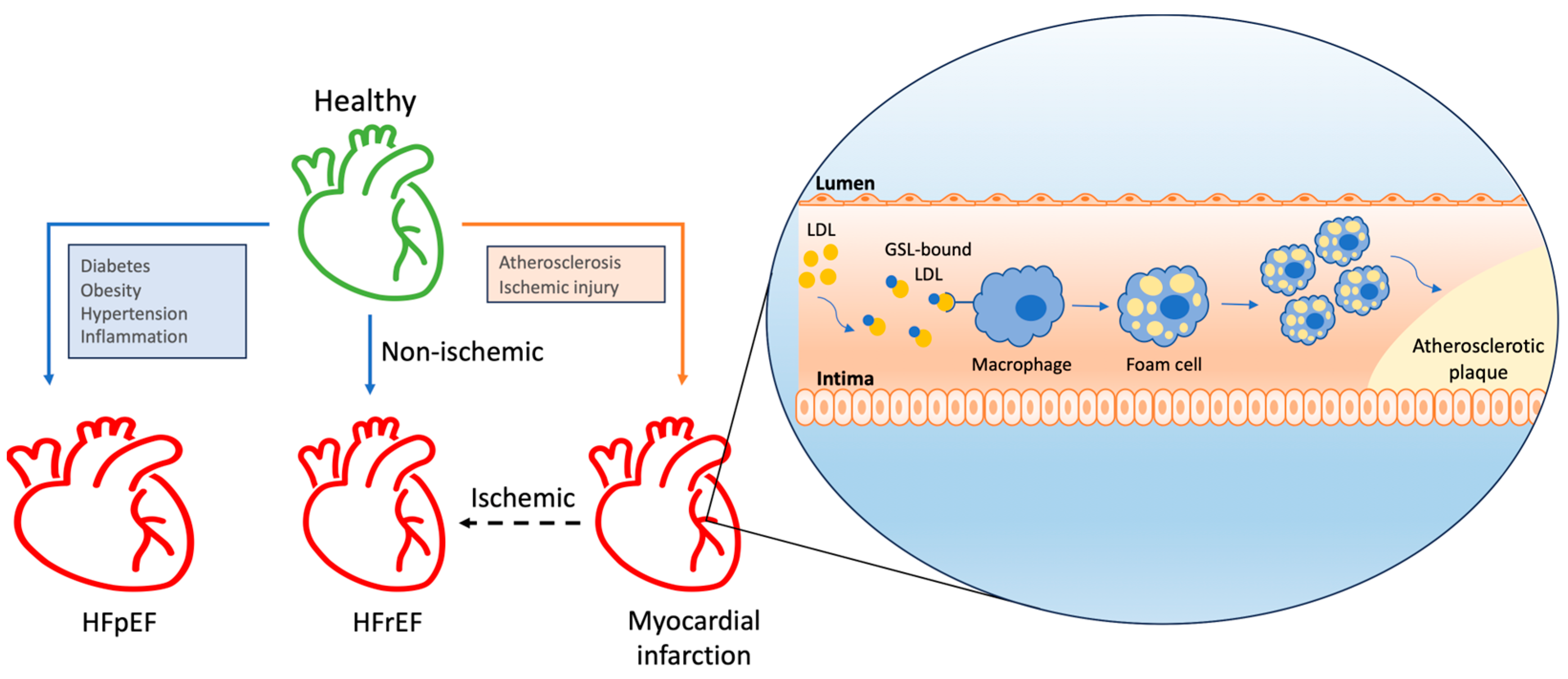 Glycosphingolipids in Cardiovascular Disease: Insights from Molecular ...