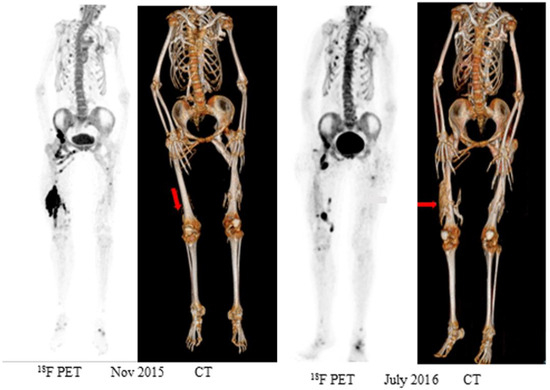 [18F]NaF PET/CT as a Marker for Fibrodysplasia Ossificans Progressiva ...