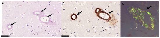 Neuroradiological Findings in Cerebral Amyloid Angiopathy with a ...