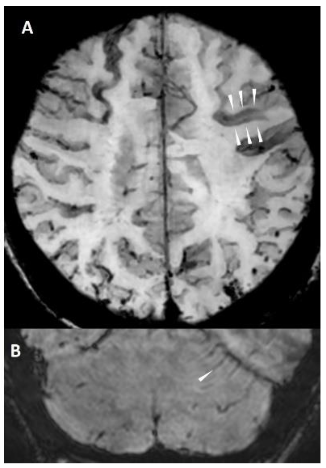 Neuroradiological Findings in Cerebral Amyloid Angiopathy with a Particular Consideration of the ...