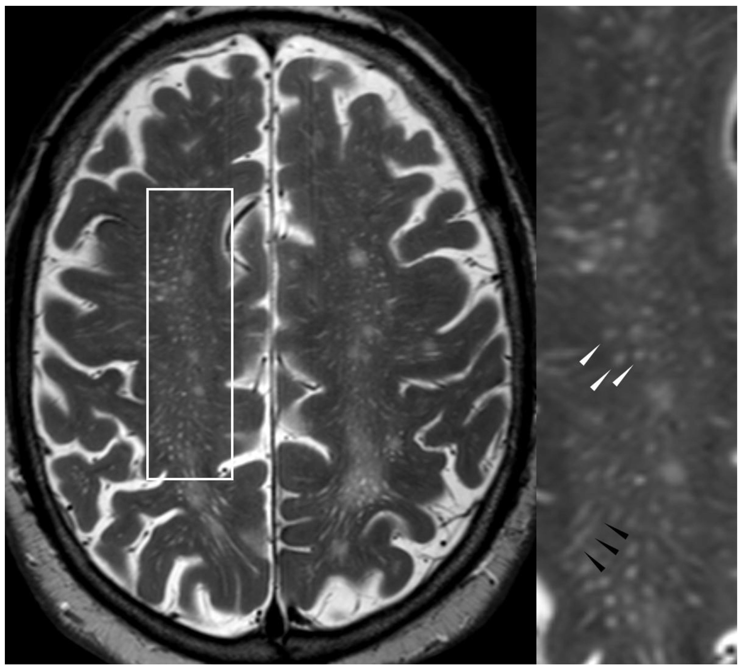 Neuroradiological Findings in Cerebral Amyloid Angiopathy with a Particular Consideration of the ...