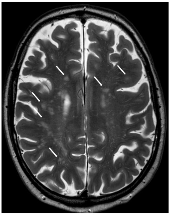 Neuroradiological Findings in Cerebral Amyloid Angiopathy with a ...