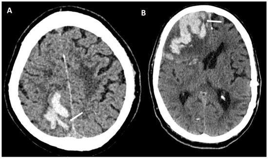 Neuroradiological Findings in Cerebral Amyloid Angiopathy with a ...