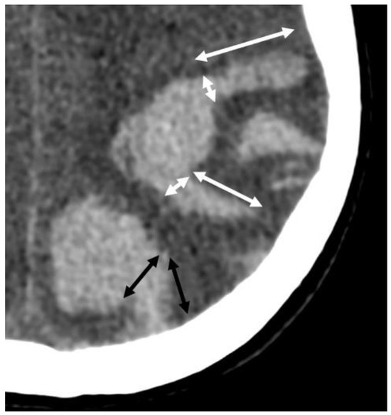 Neuroradiological Findings in Cerebral Amyloid Angiopathy with a ...