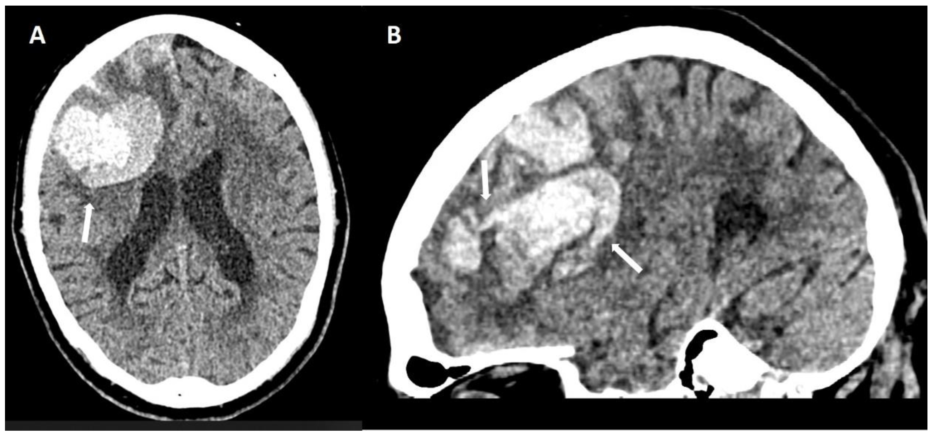 Neuroradiological Findings in Cerebral Amyloid Angiopathy with a Particular Consideration of the ...