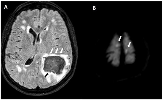 Neuroradiological Findings in Cerebral Amyloid Angiopathy with a ...