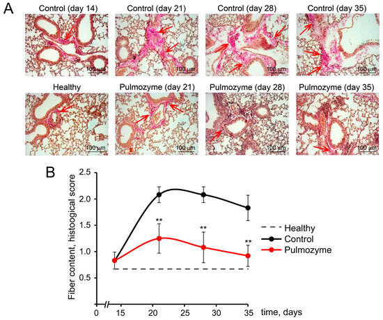 Pulmozyme Ameliorates LPS-Induced Lung Fibrosis but Provokes Residual ...