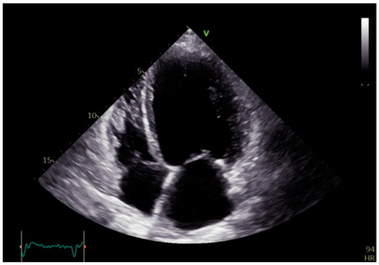 The Functional and Imaging Implications of Left Bundle Branch Pacing in ...