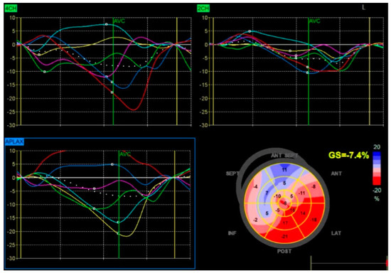 The Functional and Imaging Implications of Left Bundle Branch Pacing in ...