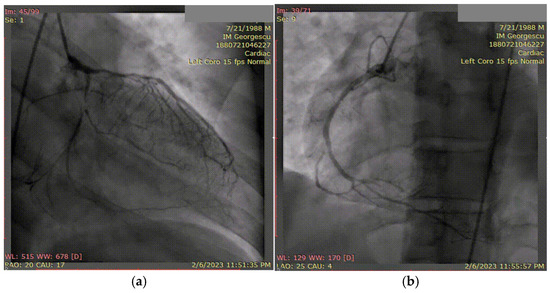 Myocardial Infarction in Young Adults: A Case Series and Comprehensive ...
