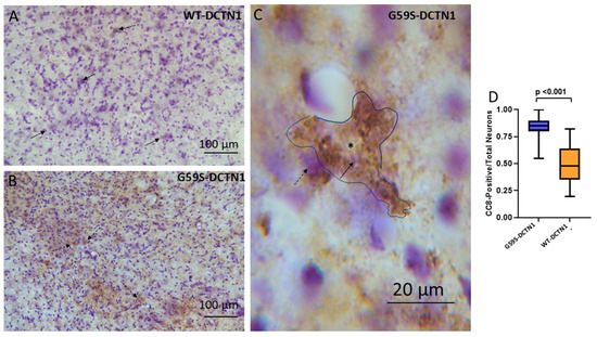 Human Mutant Dynactin Subunit 1 Causes Profound Motor Neuron Disease ...